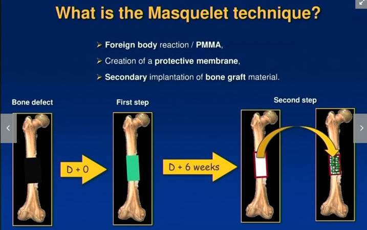 Treatment of large bone defects | OrthoVetSuperSite